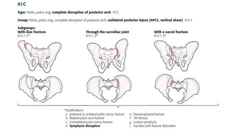 Pelvis Fracture Dislocation Pptx Pelvis Fracture Dislocation Pptx