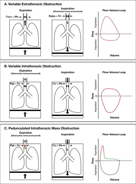 Large Endotracheal Tumour Presenting As Severe Copd Flow Volume Loop