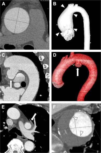 Preoperative Imaging Of The Thoracic Aorta Radiologic Clinics