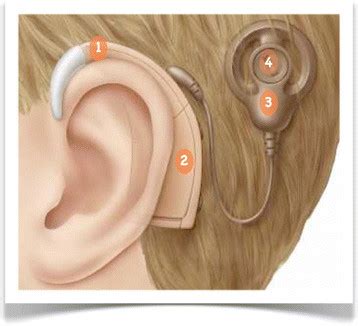 Cochlear Implant External Part 1 Microphone 2 Speech Processor Download Scientific