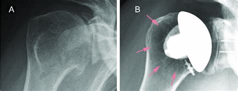 An Ap Radiograph With Automatic Exposure Control Before A And Three