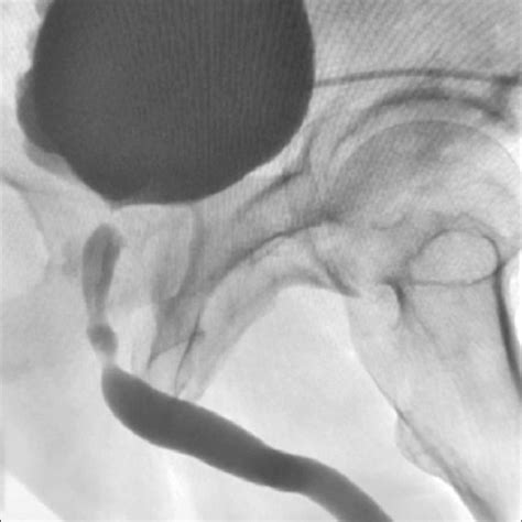 Preoperative Ascending Urethrogram Showing Bladder Neck Contracture