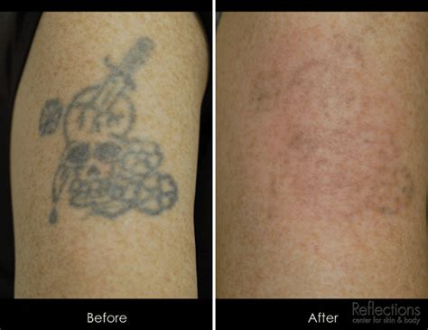 Aspirin Complex Tattoos