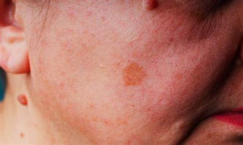 What Is Autoimmune Rash Artofit