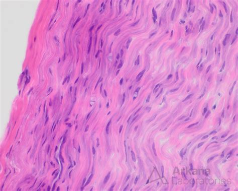 Nerve Vasculitis Neuroma Neuro Notes Arkana Laboratories