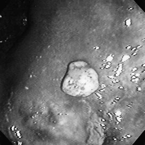 Pdf Dysplasia Associated Polypoid Mucosal Lesion In A Pelvic Pouch After Restorative