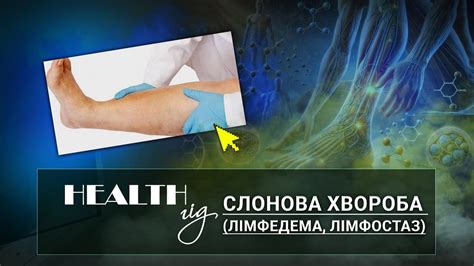 «health гід Слонова хвороба лімфедема лімфостаз Youtube
