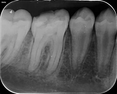 Cases Caendodonticsltd Dentures Save Your Tooth Root Canal Before And After
