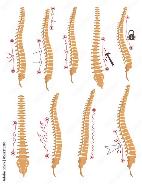 Vector De Stock Spinal Deformity Types Symbols Of Spine Curvatures Or