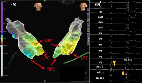 A 3d Activation Mapping Of Pulmonary Artery With Cusps With Relation Download Scientific