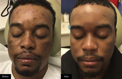Trending Beauty Treatments For Men Smyyle