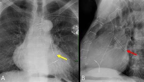 Amulet Left Atrial Appendage Closure Device