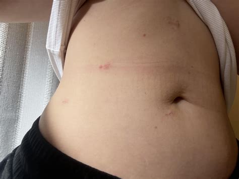 Laparoscopic Cholecystectomy After Procedure Photos R Gallbladders