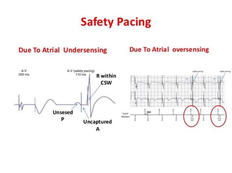 Understanding Pacemakers