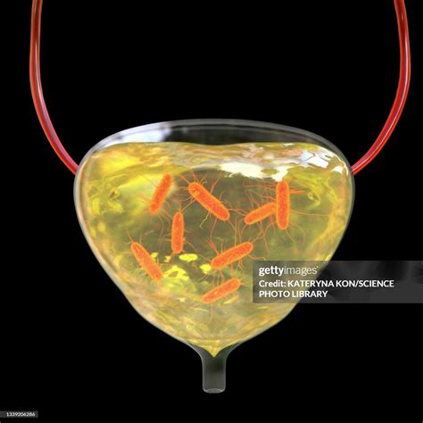 Bacterial Cystitis Illustration High Res Vector Graphic Getty Images