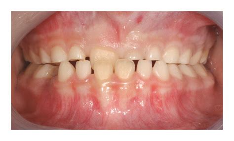 Frontal View Of The Patient Class Iii Occlusion Download Scientific