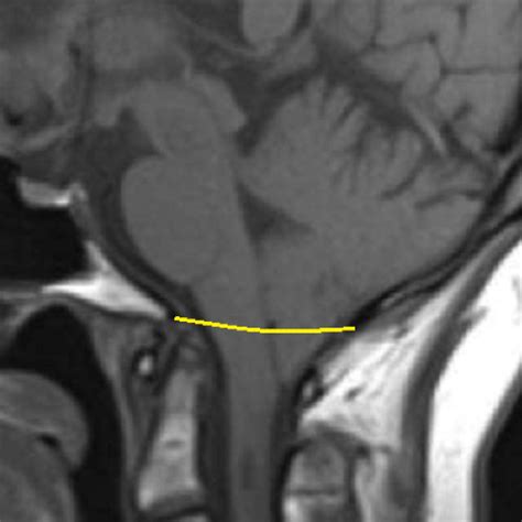 Chiari 1 5 Malformations Explained Chiari Bridges