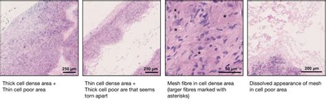 Evaluation Of Mesh Remnants Representative Images Of Thick And Thin Download Scientific