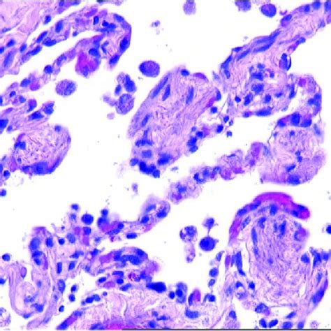 Microscopic Examination Revealed Flat Squamous Cells In The Lumens Of Download Scientific