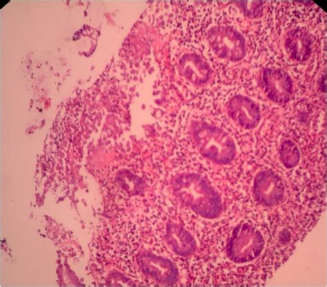 Pathology Outlines Amebic Pathology Outlines Amebic