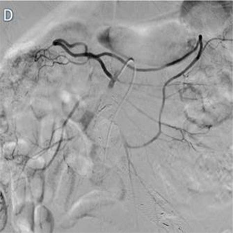 Interlock 18 And Onyx Embolization Endoleak Type Ii Direxion™ Torqueable Microcatheters