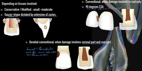 Class Iii Composite Restoration Flashcards Quizlet
