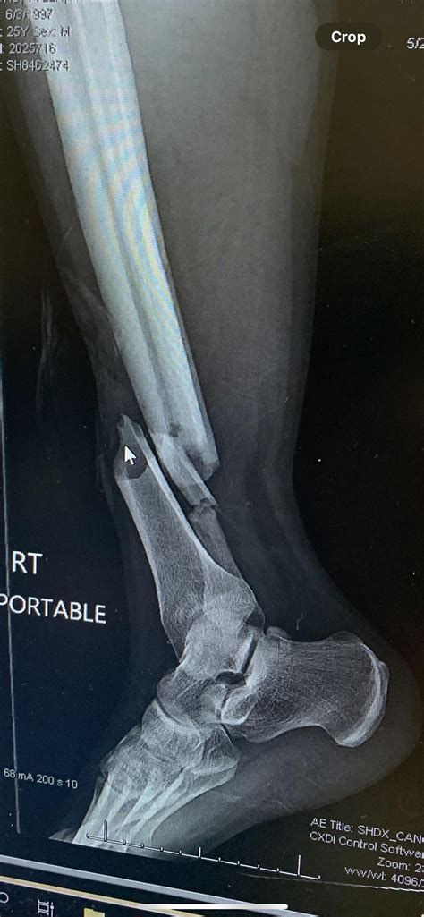 Compound Fracture Tib Fib Recovery R Brokenbones
