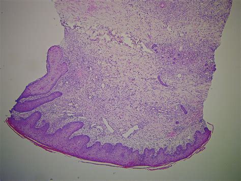 Numerous Dilated Vessels With Moderate Dermal Inflammatory Infiltrate Download Scientific Diagram