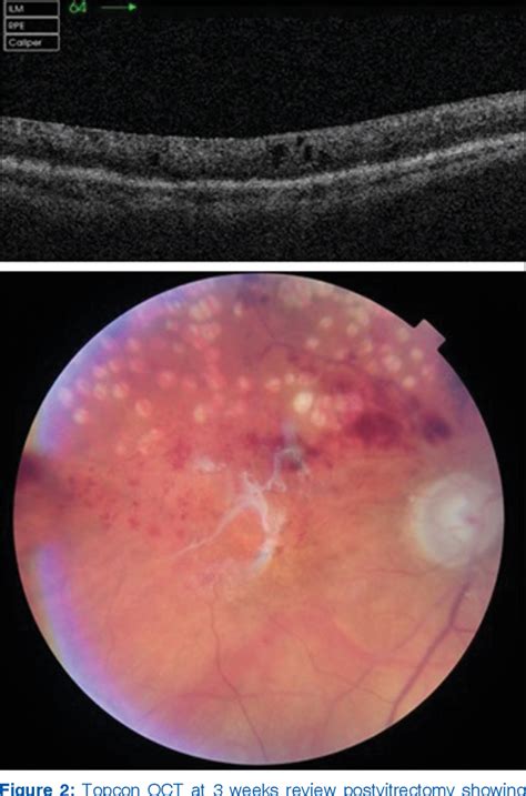 Staphylococcus Lugdunensis Endophthalmitis Following Dexamethasone