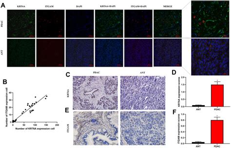 Alteration Of Tumor Associated Macrophage Subtypes Mediated By Krt6a In Pancreatic Ductal