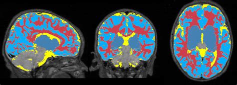 Displays The 1 Mm Isotropic Binary Masks Created By Neors From Mantis