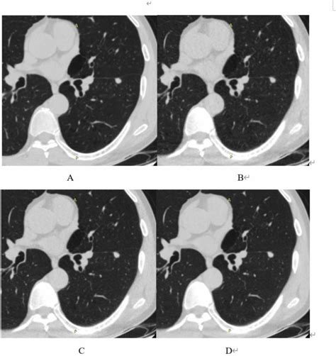 Application Of Deep Learning Image Reconstruction In Low Dose Chest Ct Scan Pmc