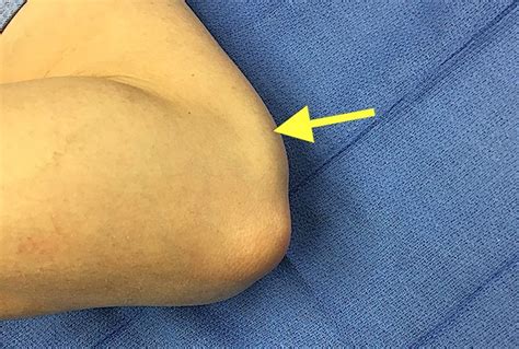 Ulnar Nerve Subluxation Hand Surgery Resource