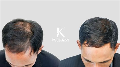 PRP Before And After Proven Results For Thicker Hair