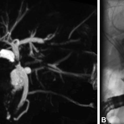 Filling Defect Of Common Bile Duct As Shown By Magnetic Resonance Download Scientific Diagram