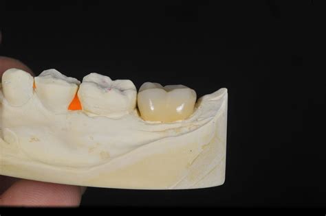 Lithium Disilicate Wissden