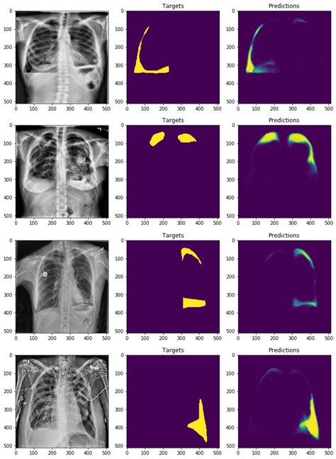 พัฒนาโปรแกรม Ai การแพทย์ วินิจฉัยภาวะปอดรั่ว Pneumothorax อัตโนมัติ จากฟิล์ม X Ray โดยใช้