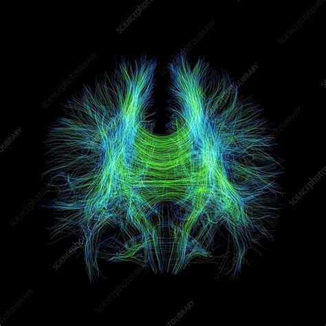 Brain Fibres 3d Diffusion Tensor Imaging Dti Magnetic Resonance Imaging Mri Scan Of Nerve
