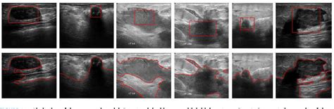 Figure 14 From Robust Active Contour Model Using Patch Based Signed Pressure Force And Optimized