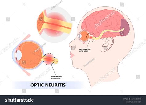 Devic S Disease Of Signs