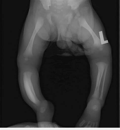 Hyperostosis Of The Bilateral Tibia Bone Involving The Anterior Cortex Download Scientific
