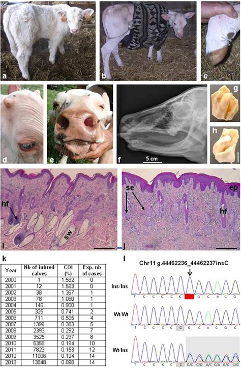 Identification Of A De Novo Mutation Causing Recessive Anhidrotic