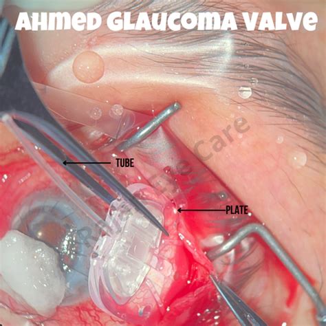 Ahmed Glaucoma Valve — Ophthalmobytes
