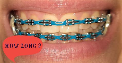 Power Chain Braces: uLTIMATE GUIDE 2025 - toothcareusa.com