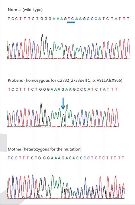 Portion Of The Sequencing Electropherograms Of Exon Of The AR Showing Download Scientific