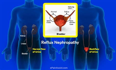 Reflux Nephropathy Treatment Causes Symptoms Signs