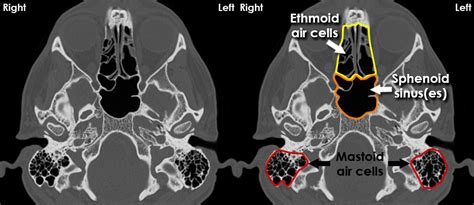 Valleculae And Pyriform Sinuses