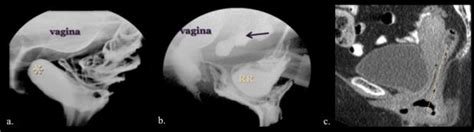 Multimodality Imaging Review Of Anorectal And Perirectal Diseases With