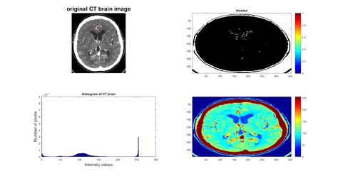 Biomedical Signal And Image Processing Projects Using Matlab And Labview Tools Ct Scan Of Brain