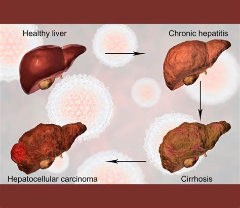 Understanding Liver Cancer Comprehensive Guide